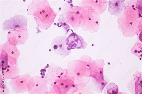 Abnormal Pap Smear Hpv