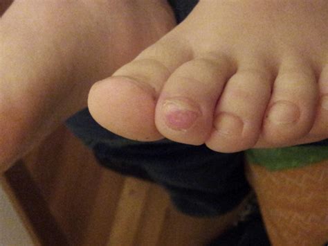 Subungual Exostosis The Journal Of Pediatrics