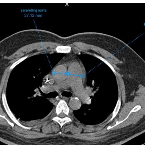Measurement Is Performed At The Level Of Pulmonary Artery Bifurcation