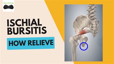 Can Ischial Bursitis Cause Rectal Pain High Da And