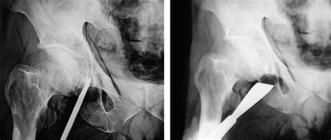 Anterior Appearance Of A The Pubis And B And Ischium Osteotomies In