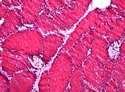 Glycogen Storage Diseases Libre Pathology
