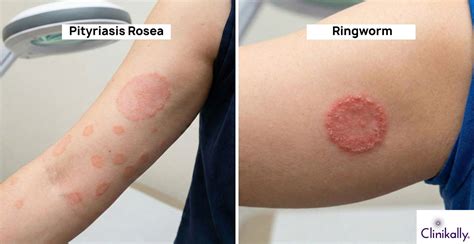 How To Tell If Your Rash Is Pityriasis Rosea Or Ringworm Clinikally