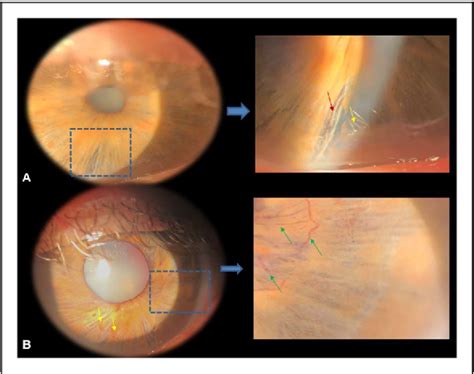 Figure 1 From Atypical Presentation Of Bilateral Iridoschisis With