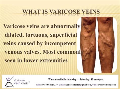 Know About Varicose Veins Best Treatment For Varicose Veins Ppt