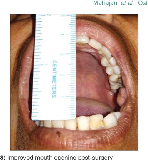 Figure 8 From Giant Osteochondroma Of The Mandibular Condyle And Temporomandibular Joint A
