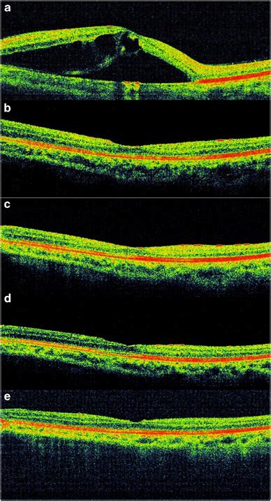 Preoperative Serous Macular Detachment And Large Schisis Cavity In The