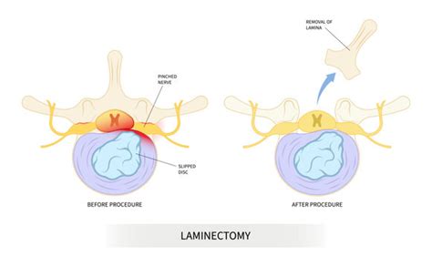 Laminectomy