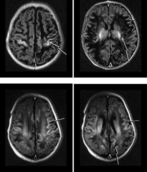 Cortical Highlighting A Mild Highlighting Around Central Fissure