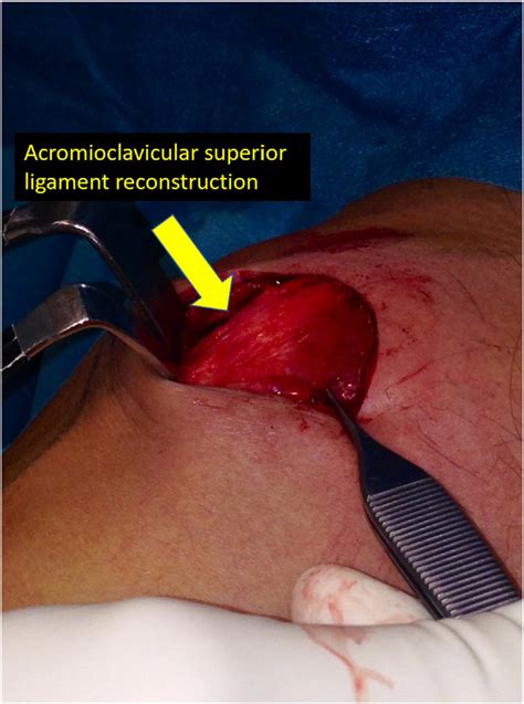 Final Image Of The Acromioclavicular Stabilization And Reconstruction
