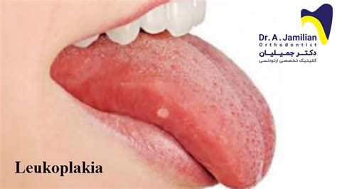 White Lesions Or Leukoplakia Dr Jamilian