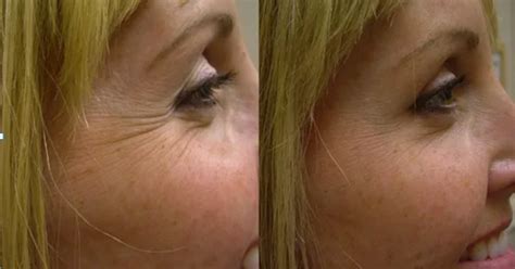 3 Natural Ways To Get Rid Of Crows Feet Top 5 Diy