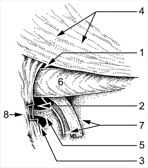 Sciatic Hernia