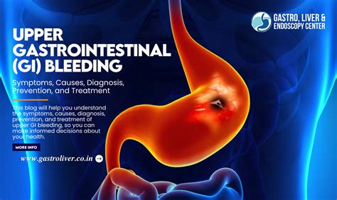 Upper Gi Bleed Symptoms One Of The Causes Of Lower Gi Bleeding Is