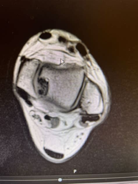 Christopher M Yardan Dpm Facfas On Linkedin Subchondralsolutions Oats Footandanklesurgery