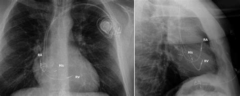 Biventricular Pacemaker Chest X Ray