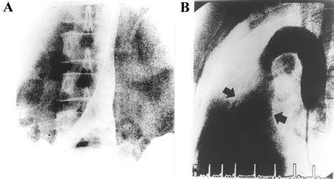 A Venogram Postero Anterior View Showing A Left Sided Inferior Vena