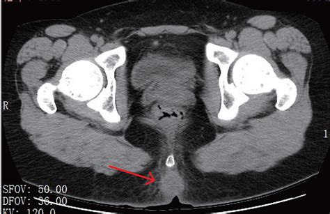 Case Report A Rare Case Of Pilonidal Abscess Caused By Coinfection Of Idr