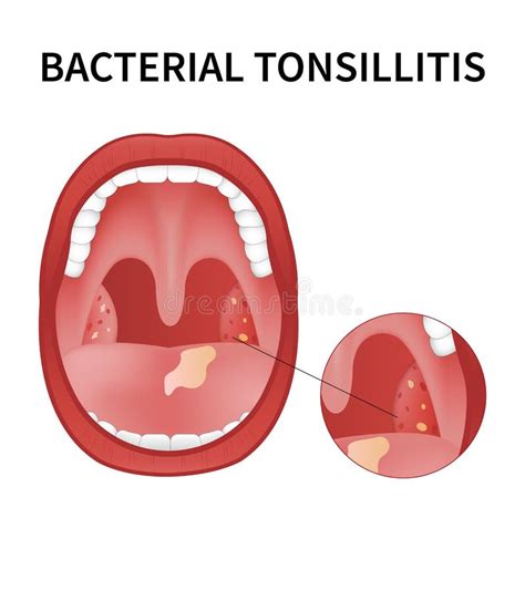 Bacterial And Viral Tonsillitis Angina Pharyngitis And Tonsillitisopen Mouth Stock Image