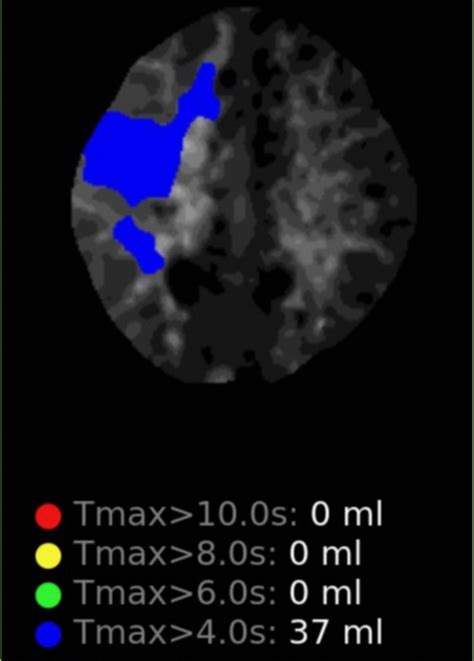 Indirect Edas Revascularization Treats Moya Moya Syndrome Nspc Brain And Spine Surgery