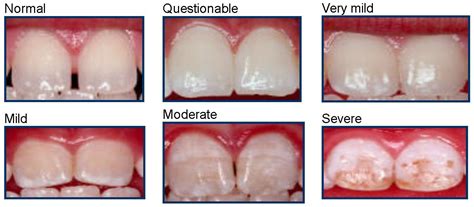 Dentistry And Medicine Dental Fluorosis