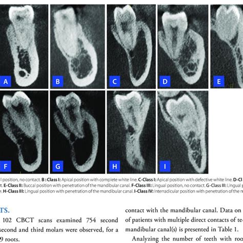 Relation Of Root Apices To The Mandibular Canal † The Mandibular Download Scientific Diagram