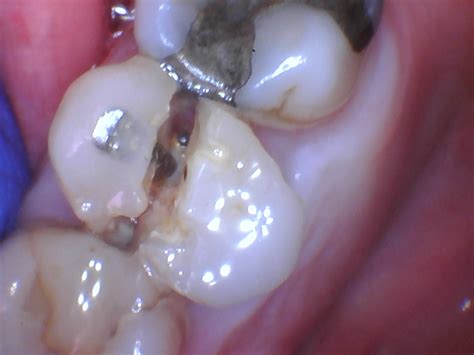 Why Your Dentist May Recommend A Crown Or Cuspal Coverage Restoration