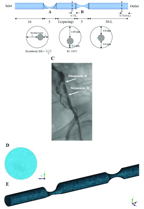Top Schematic Diagram Of Serial Stenoses With One Eccentric Stenosis