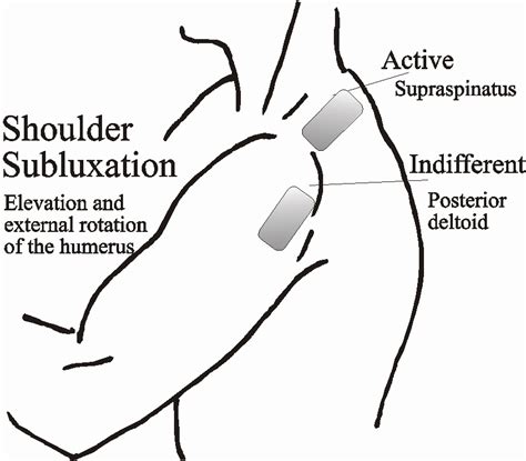 Fest Newsletter Info On E Stim Placement For Subluxation General Ue After Stroke Stroke