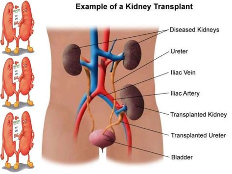 Ckd Ppt Copy Pptx Presentations Of Ckd Ppt