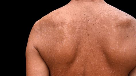 White Spots On The Skin Possible Causes And Treatments