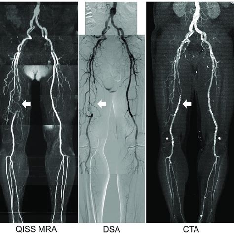 Angiogram Of A 52 Year Old Male With Right Sided Claudication Stage
