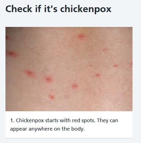 Early Chicken Pox Chickenpox Varicella Symptom Evaluation