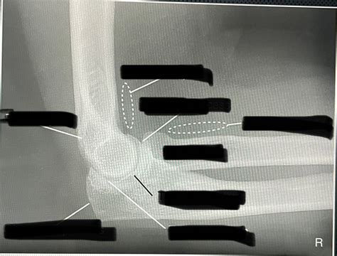 Lateral Elbow Diagram Quizlet