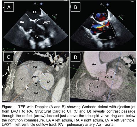 Acquired Gerbode Defect As A Late Complication Of Mitral And Tricuspid