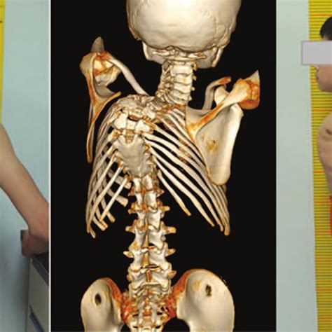 Intra Operative Photograph Showing Posterior Vertebral Column Resection