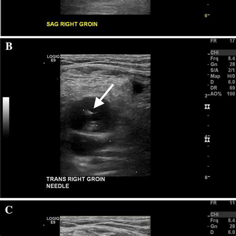 A 76 Year Old Man With Right Femoral Artery Pseudoaneurysm After Download Scientific Diagram