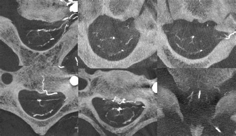 The One Off Club — Thyrocervical Trunk Fistula