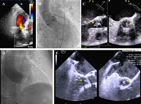 Representative Cases Of Tavi Endocarditis An 84 Year Old Woman With