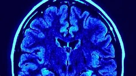 Sex And Gender Influences On Nervous System Function