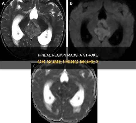 Pineal Region Mass A Stroke Or Something More Medshun
