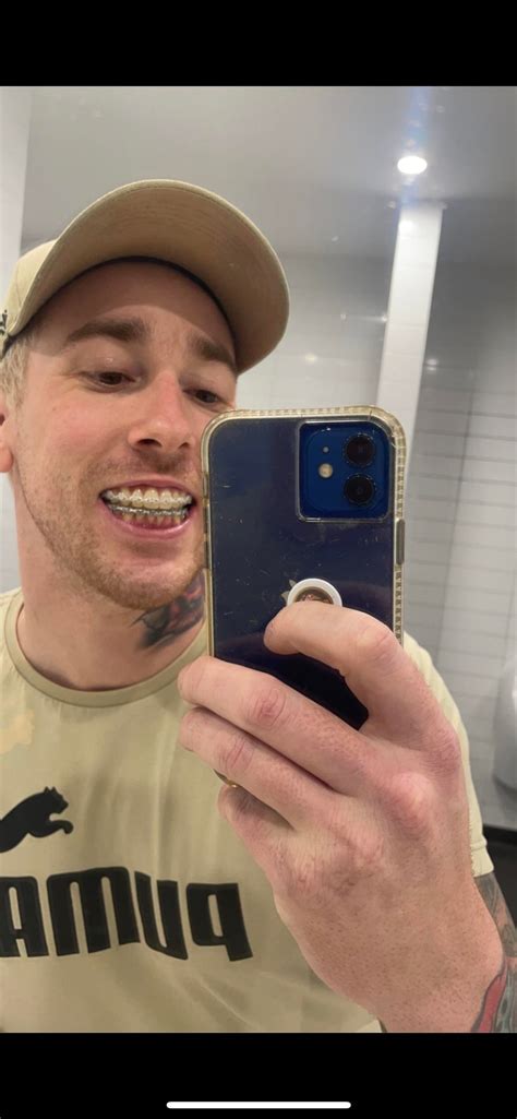 First Time Getting Mini Screws Rbraces