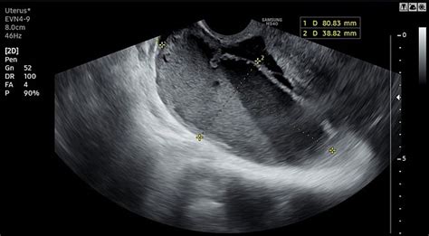 Can You See Pelvic Inflammatory Disease On Ultrasound