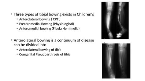 Congenital Pseudo Arthrosis Of Tibia 1pptx