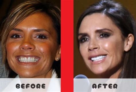 Victoria Beckham New Teeth Now Before And After Implants