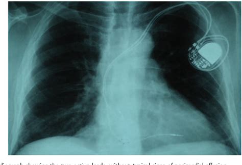 Figure 1 From Late Atrial Appendage Perforation From A Pacemaker Lead