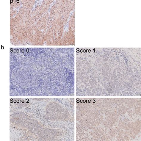 Immunohistochemical Staining Of P16 Specimens With A Nuclear Download Scientific Diagram