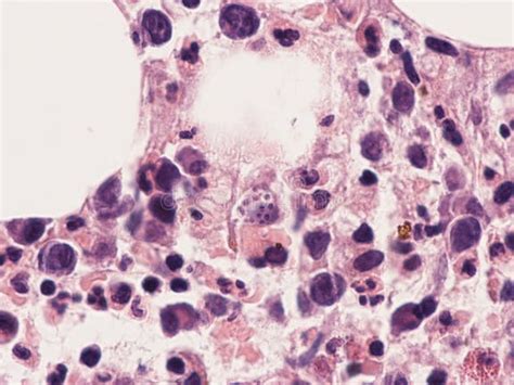 Histoplasma Capsulatum In Bone Marrow Stock Image Image Of Granuloma
