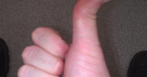 I Have Weird Thumbs Pics