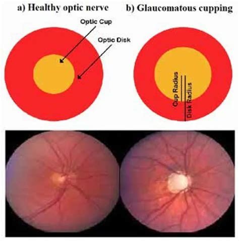 Optic Nerve Cupping Nova Eyecare